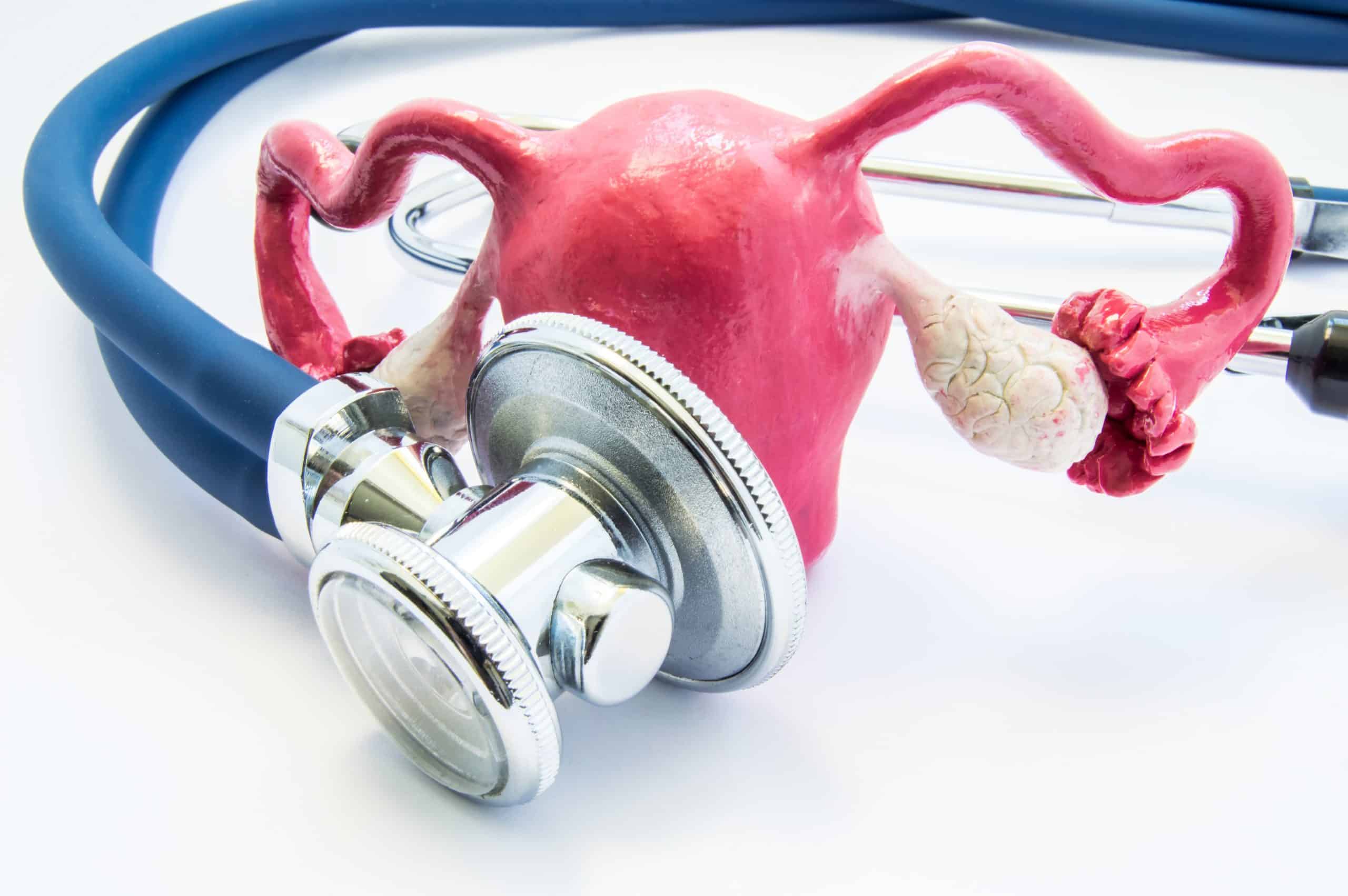 Útero en retroversión o útero invertido - Síntomas y tratamiento